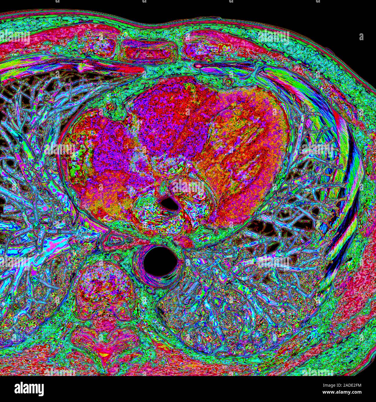 Human heart, 3D coloured computed tomography (CT) scan. This is an ...