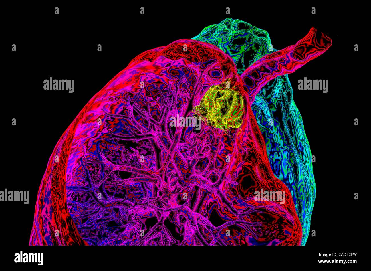 Lung cancer. Coloured 3D lateral computed tomography (CT) scan of human ...