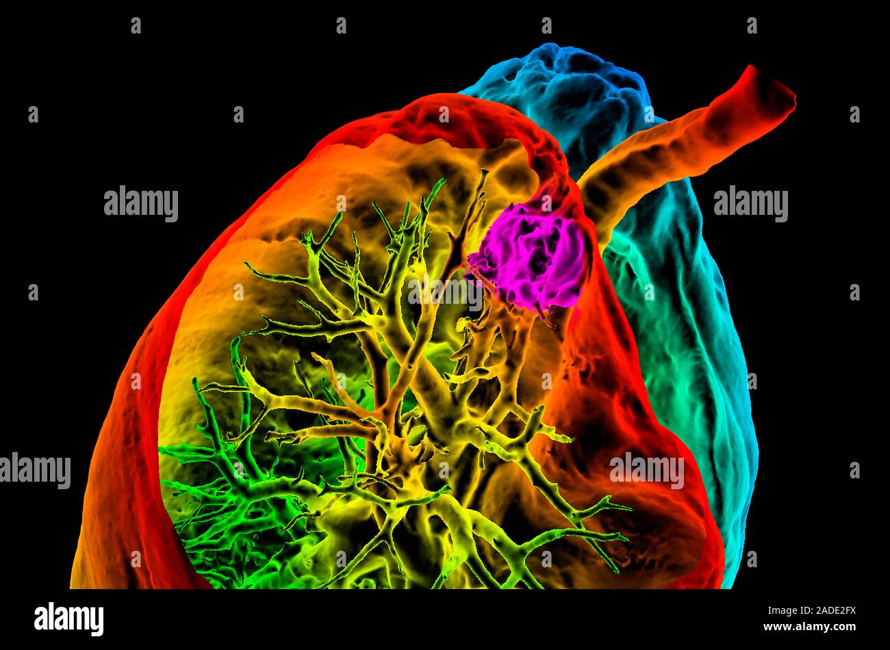 Lung cancer. Coloured 3D lateral computed tomography (CT) scan of human ...