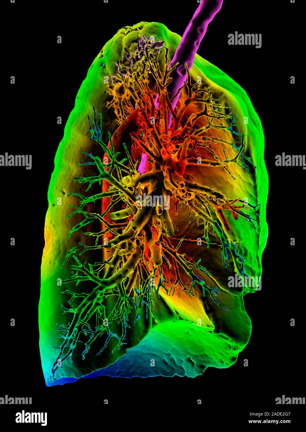 Pulmonary tuberculosis. Coloured lateral 3D computed tomography (CT ...