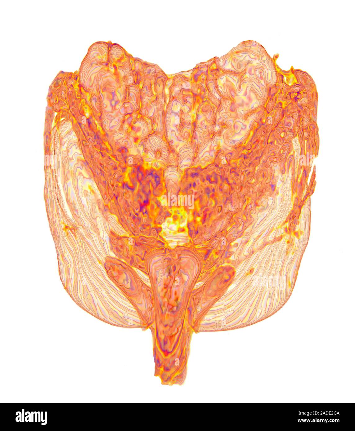 Prostate and seminal vesicles. Coloured 3D magnetic resonance imaging ...