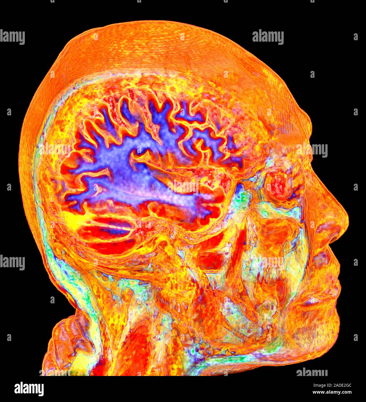 Human head and brain, coloured 3D magnetic resonance imaging (MRI) scan. This cutaway sagittal ...