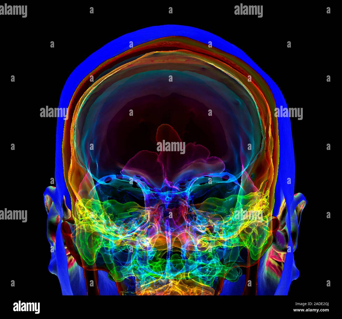 Head and skull. Coloured 3D computed tomography (CT) scan of a frontal ...