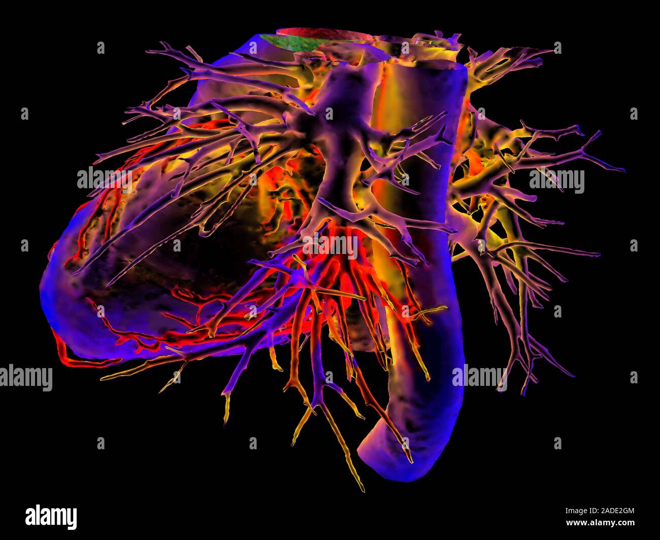 Human heart, 3D coloured computed tomography (CT) scan. This is an ...