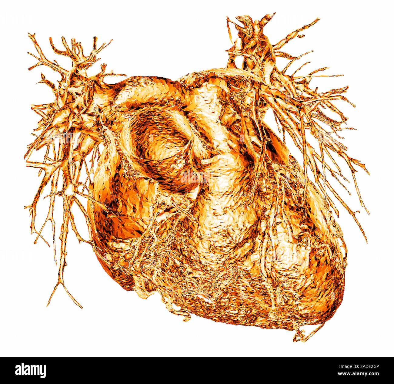 Human heart, 3D coloured computed tomography (CT) scan. This is an ...