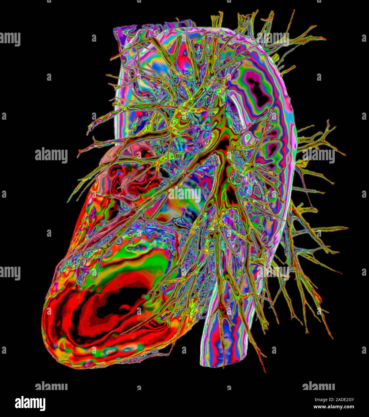 Pulmonary artery aneurysm, 3D coloured computed tomography (CT) scan. The heart is at lower left ...