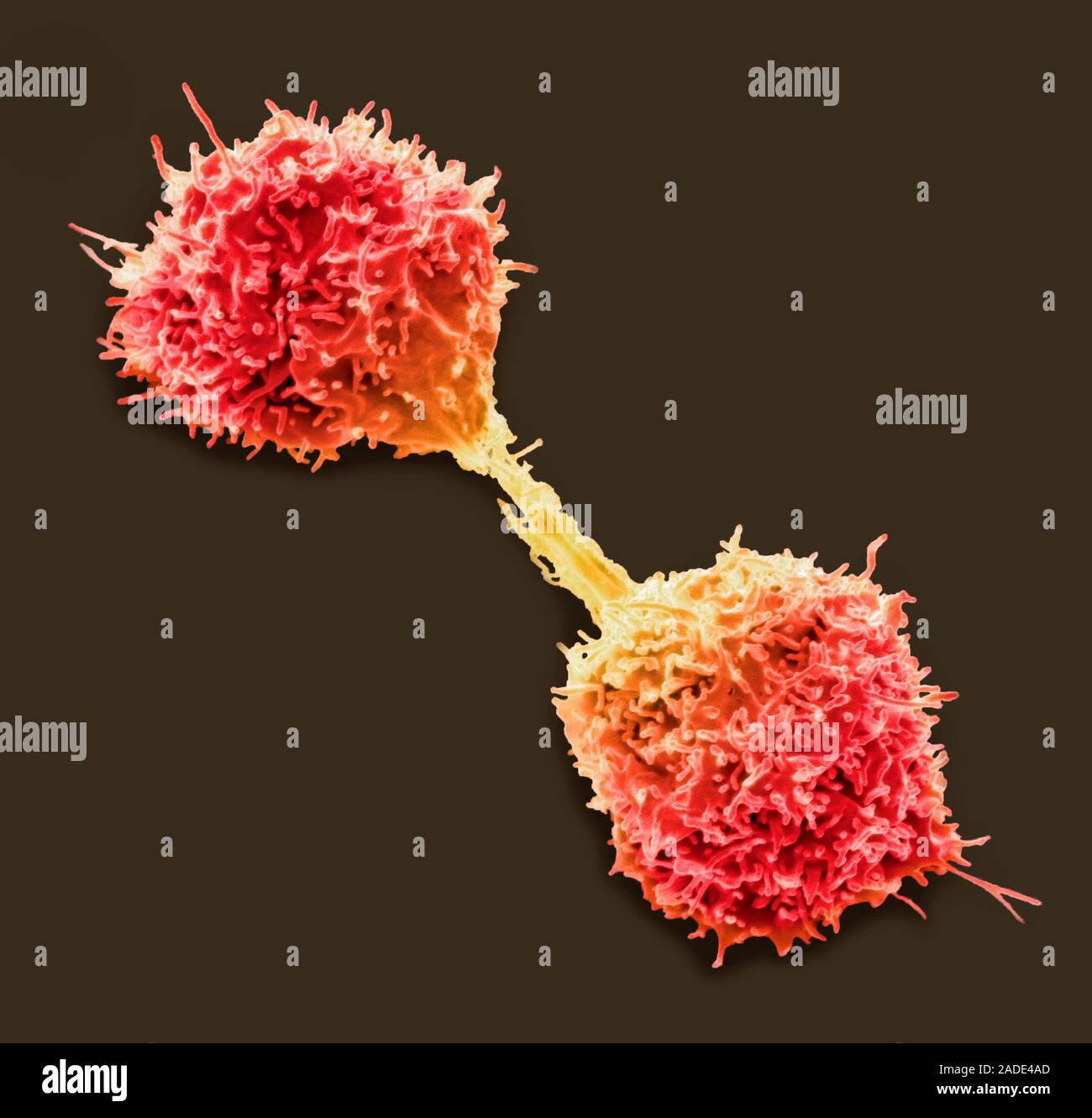 Lymphoma cancer cell. Coloured scanning electron micrograph (SEM) of ...