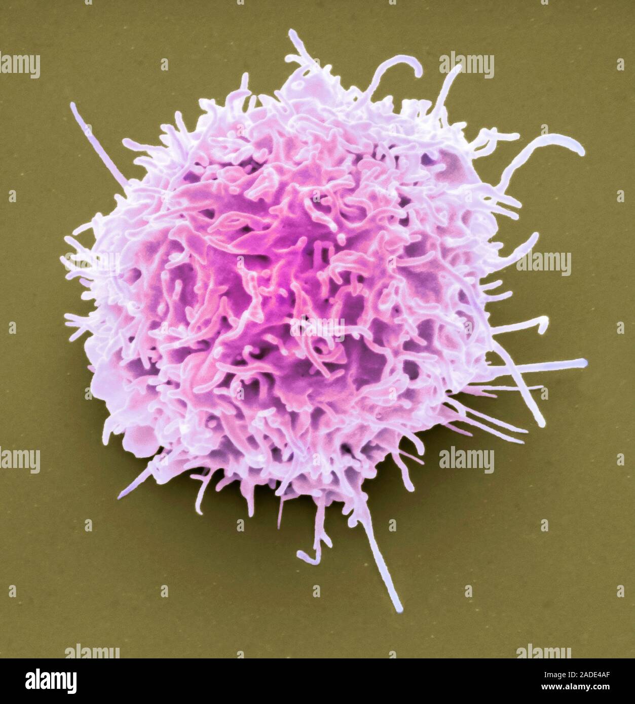 Lymphoma cancer cell. Coloured scanning electron micrograph (SEM) of a ...