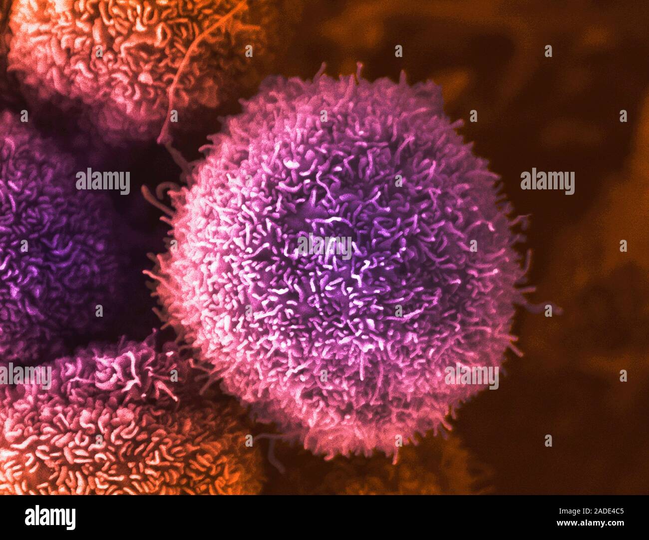 Images not to be used by the tobacco industry. Pancreatic cancer cells ...