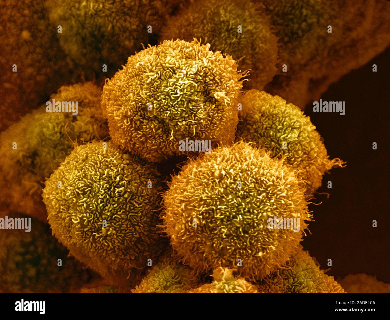 Images not to be used by the tobacco industry. Pancreatic cancer cells ...