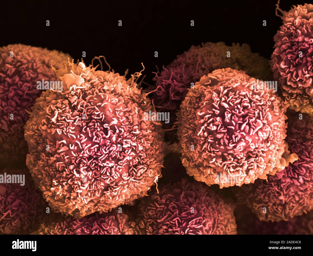 Images not to be used by the tobacco industry. Pancreatic cancer cells ...