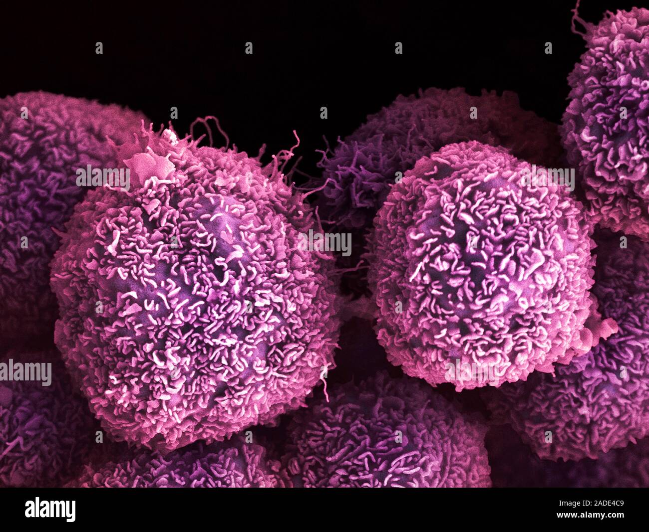 Images not to be used by the tobacco industry. Pancreatic cancer cells ...
