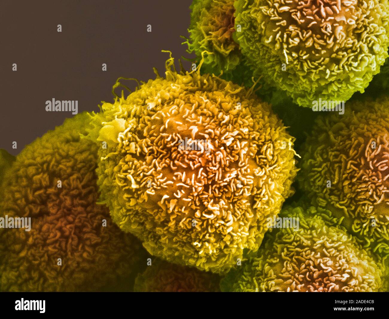 Images not to be used by the tobacco industry. Pancreatic cancer cells ...