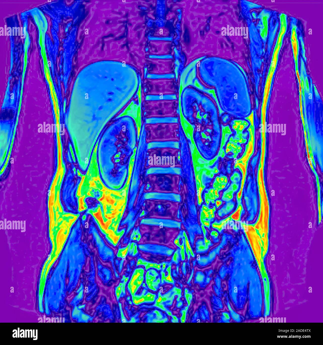 Frontal Abdomen Mri Magnetic Resonance Imaging Scan Of A 60 Year Old