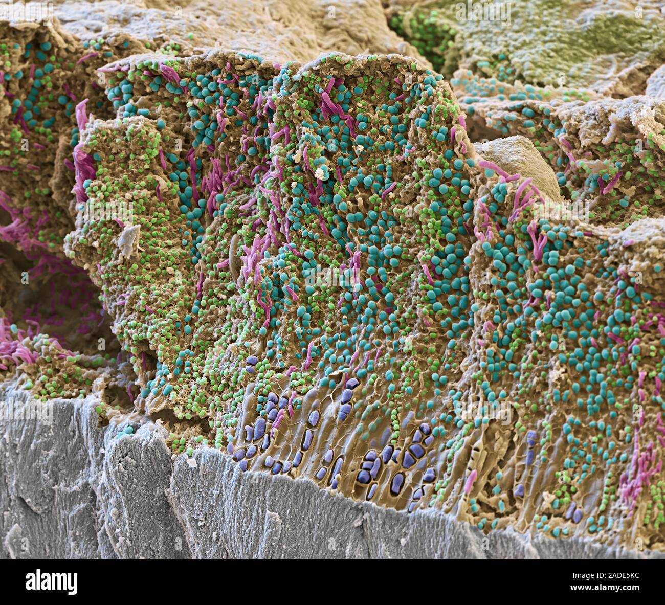 Plaque on tooth. Coloured scanning electron micrograph (SEM) showing a ...