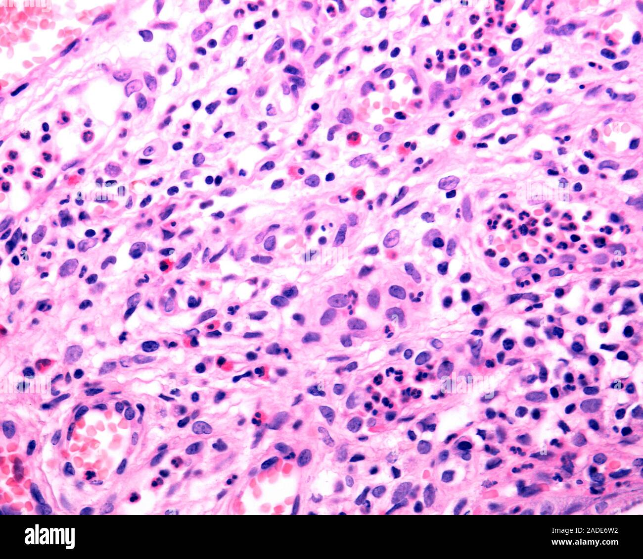 Light micrograph of connective tissue affected by an acute inflammation ...