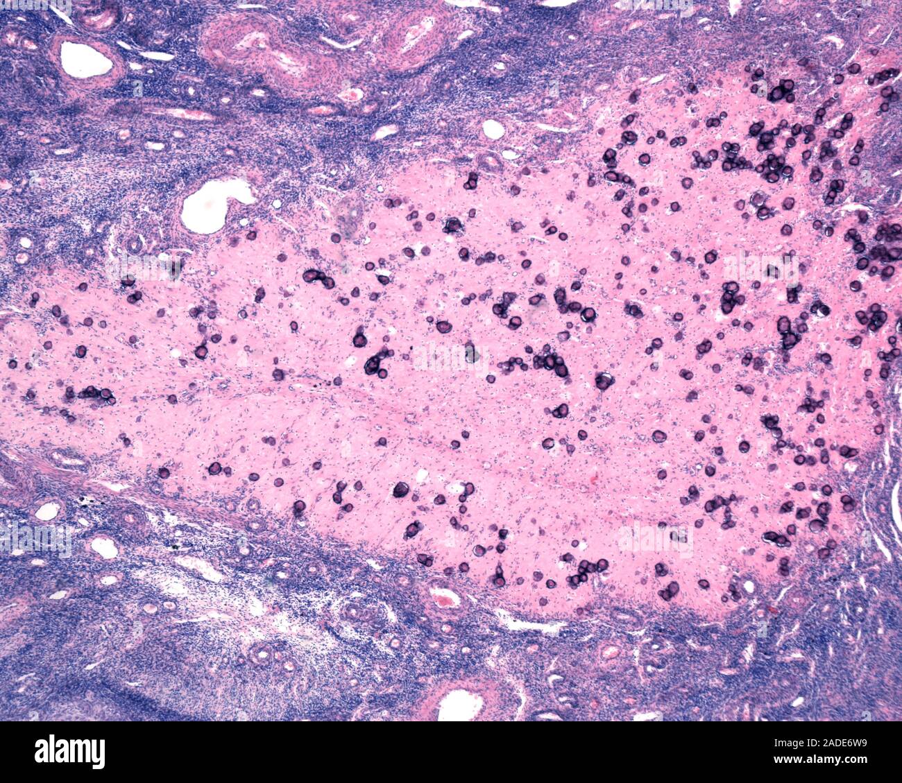 Light micrograph showing a corpus albicans in a human ovary. It appears ...