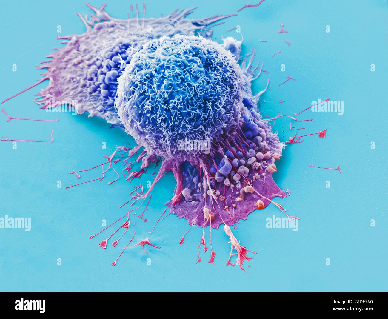Images not to be used by the tobacco industry. Lung cancer cells ...