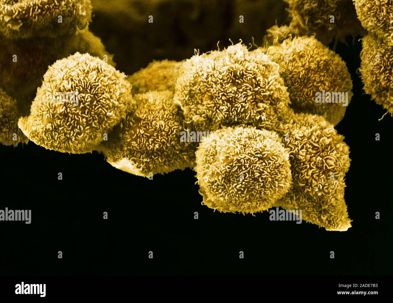 Images not to be used by the tobacco industry. Pancreatic cancer cells ...