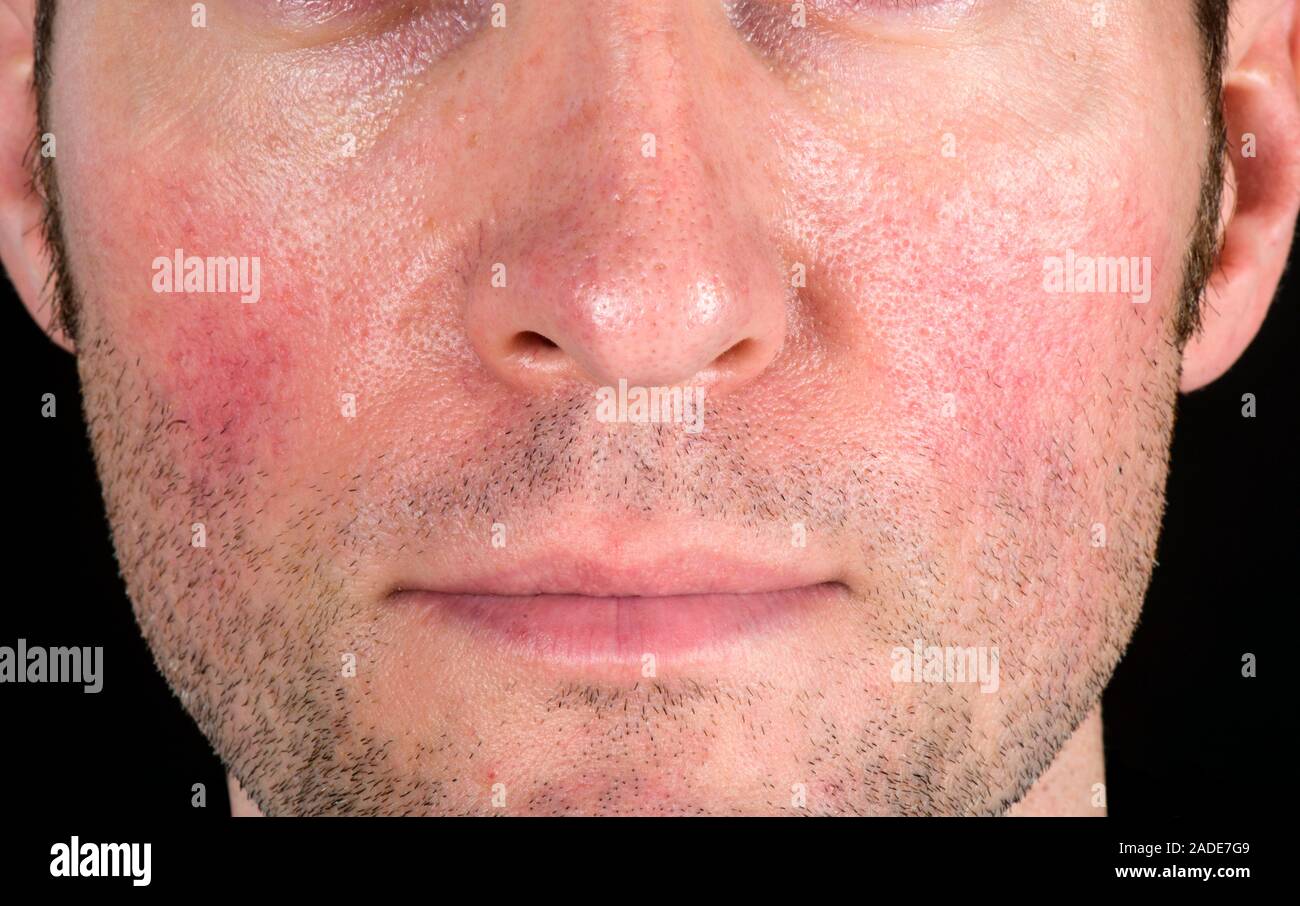 Acne rosacea on the cheeks of a 38-year-old man. This condition is a ...