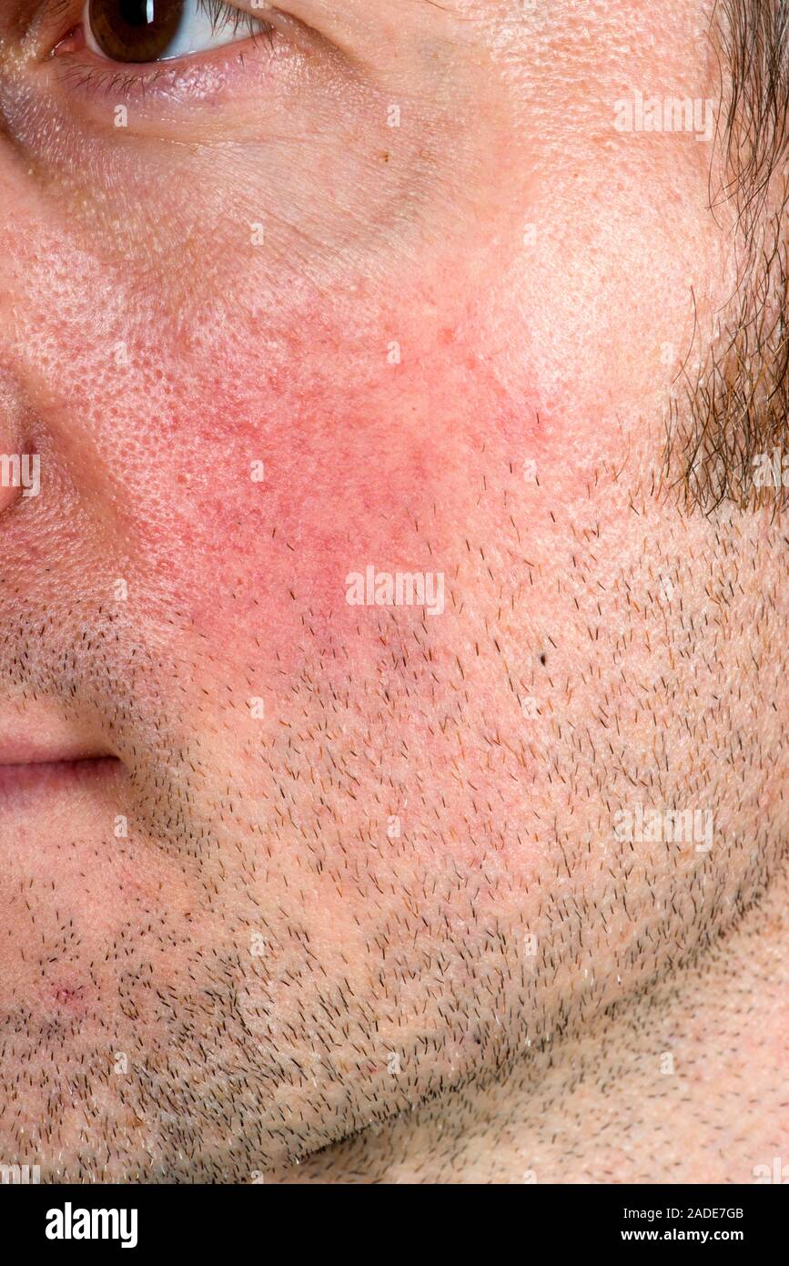 Acne rosacea on the cheek of a 38-year-old man. This condition is a ...