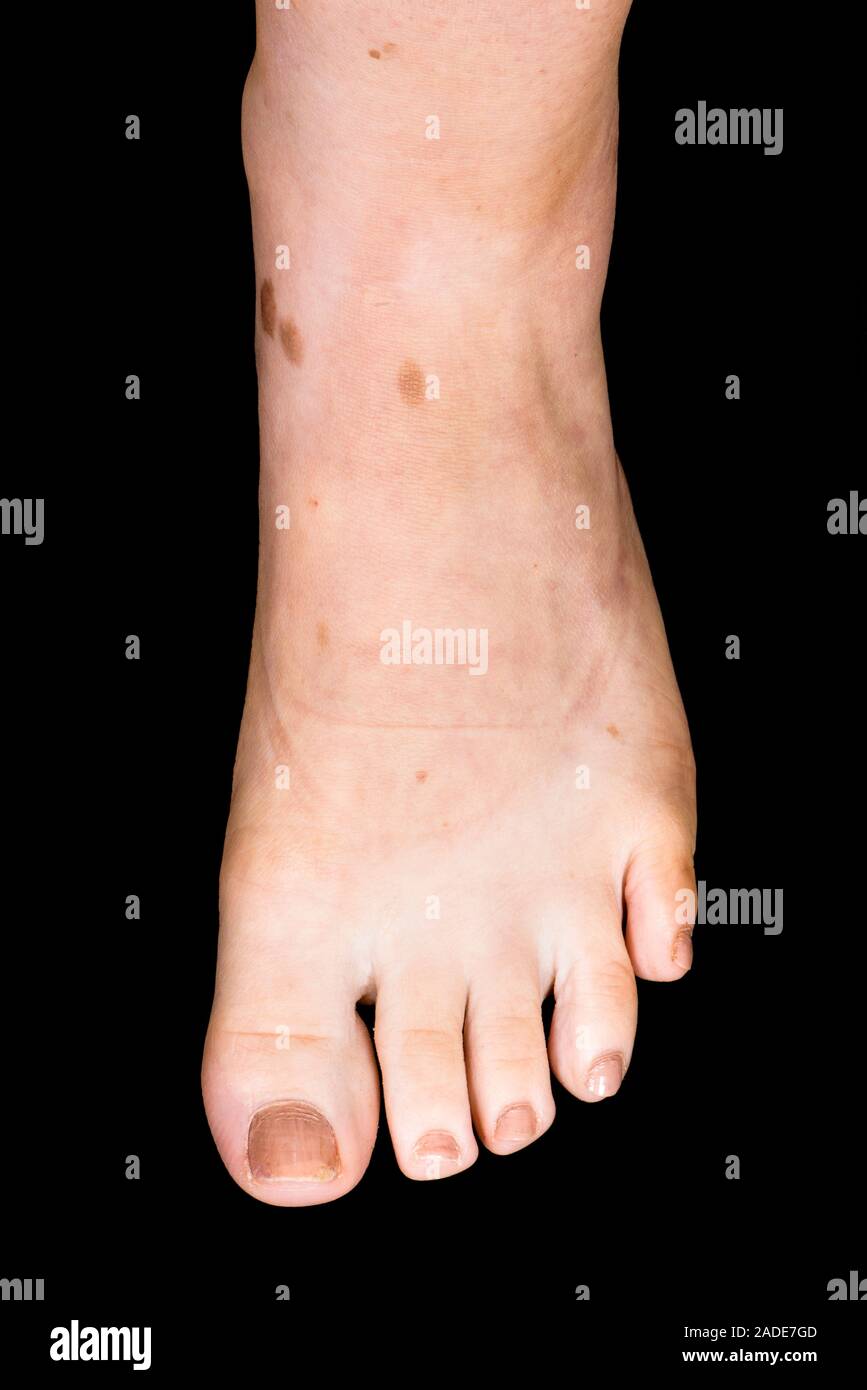 Congenital moles on the foot in a 20-year-old woman. Also known as a ...