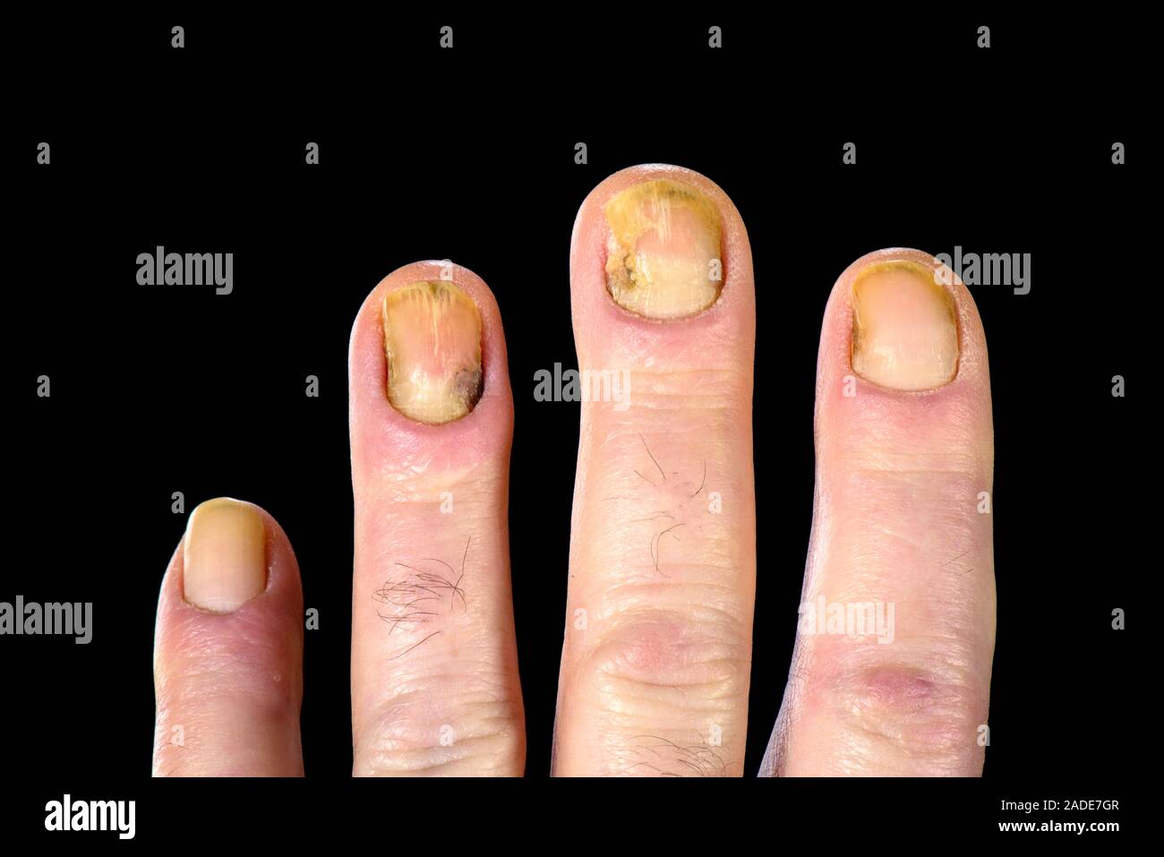 Dystrophic finger nails in a 53-year-old man. Dystrophy is a term for ...