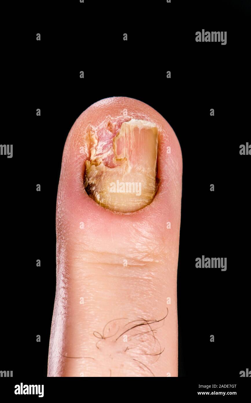Dystrophic finger nail in a 53-year-old man. Dystrophy is a term for ...
