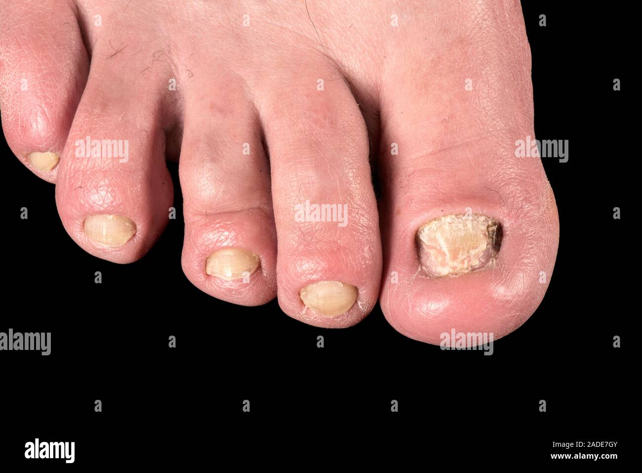 Dystrophic toe nails in a 53-year-old man. Dystrophy is a term for ...