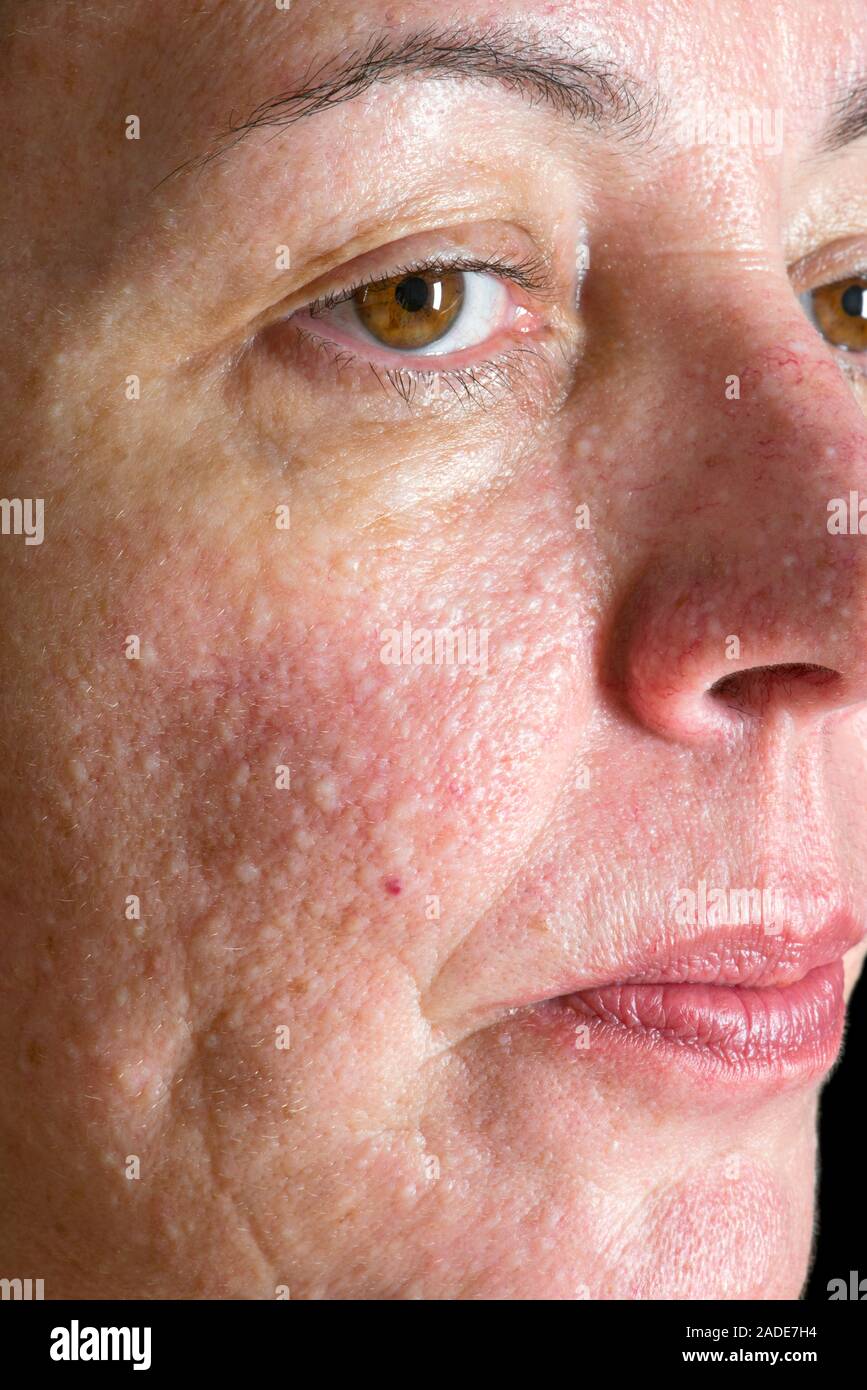 Fibrofolliculomas in Birt-Hogg-Dube syndrome. Skin papules known as ...