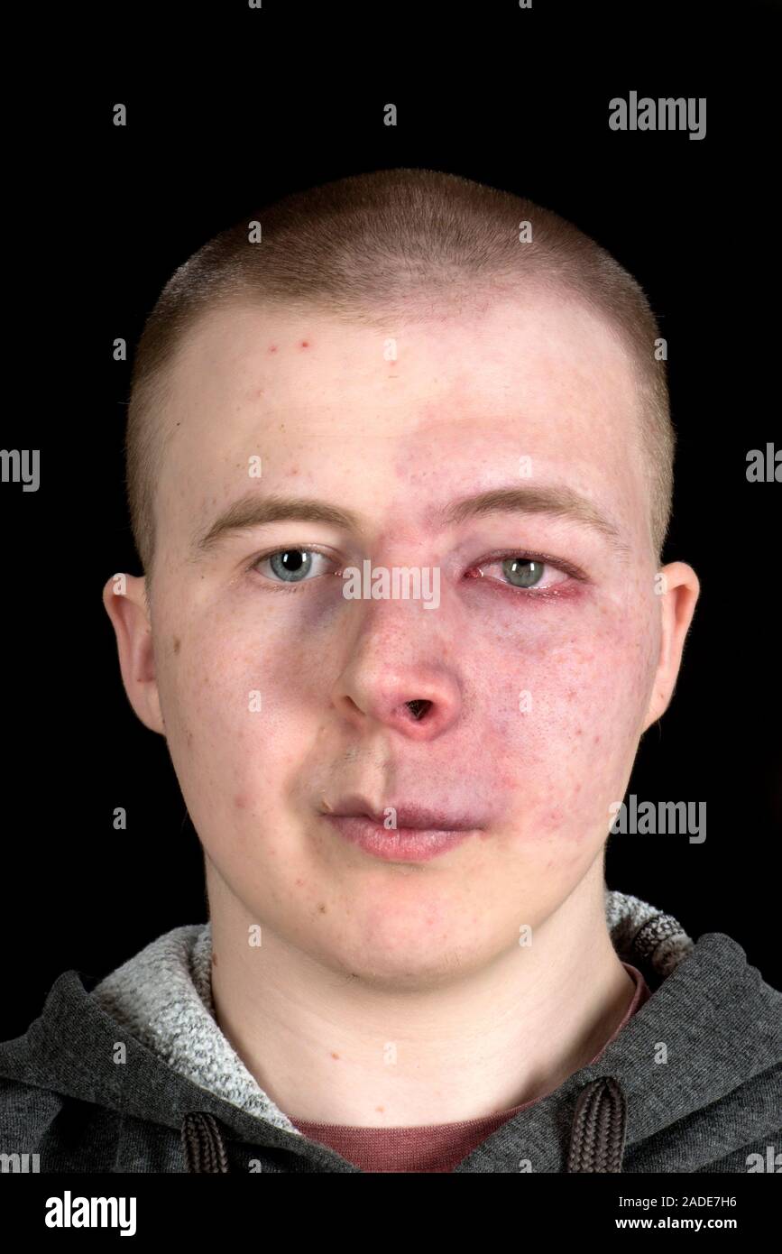 Sturge-Weber syndrome in a 22-year-old man. This congenital (present ...