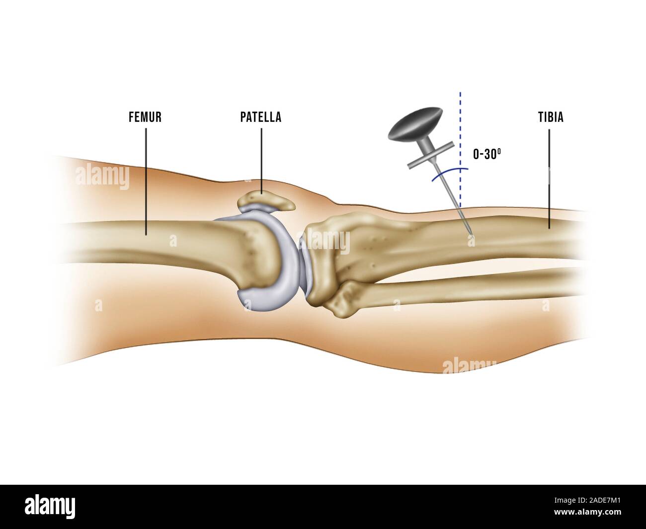Intraosseous infusion, illustration. This process is used to inject ...