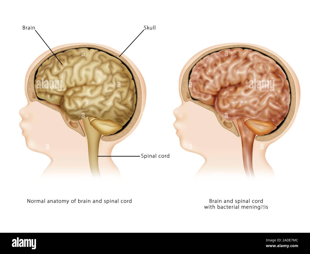 Meningitis. Illustration of the brain and spinal cord with normal ...