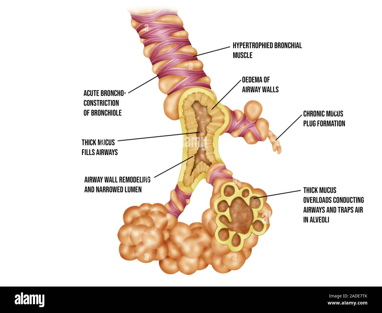 Lung Bronchioles And Alveoli In Bronchiolitis Illustration Bronchiolitis Is The Inflammation