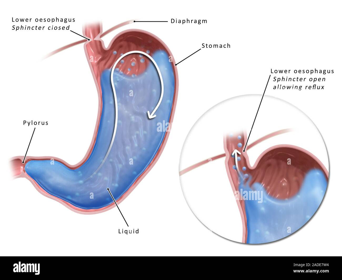Gastric reflux disorders, illustration. At upper left is a normal ...