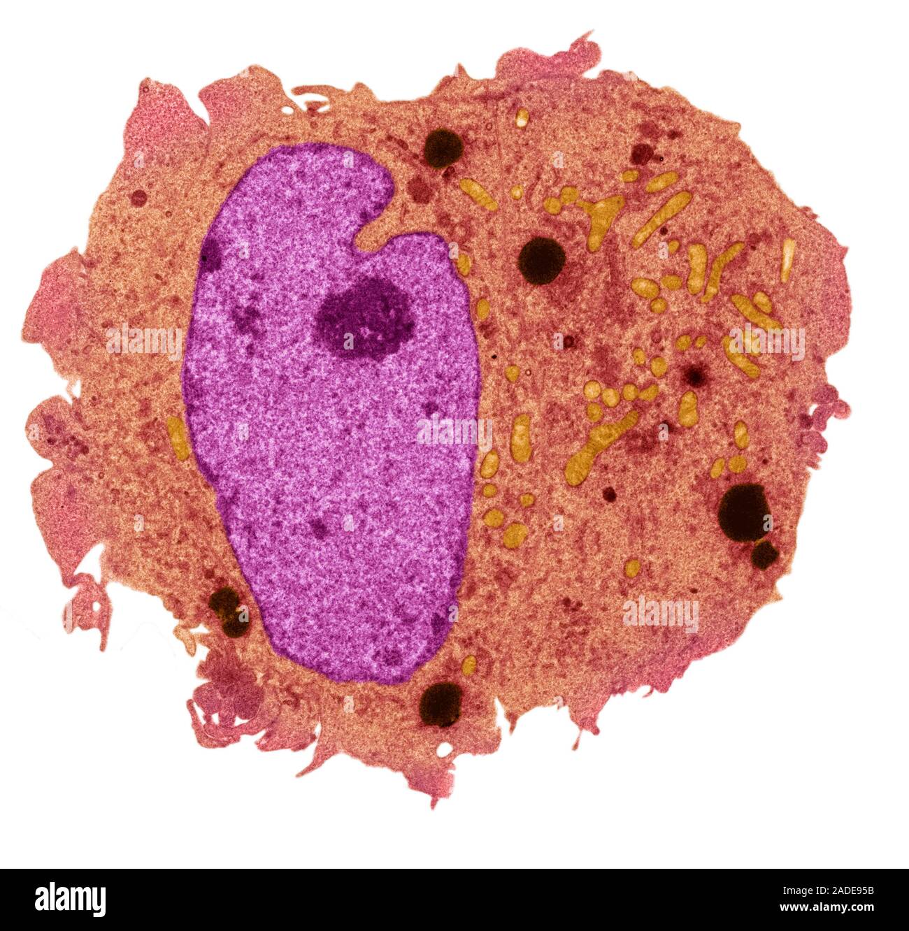 Sarcoma cell. Coloured transmission electron micrograph (TEM) of a ...