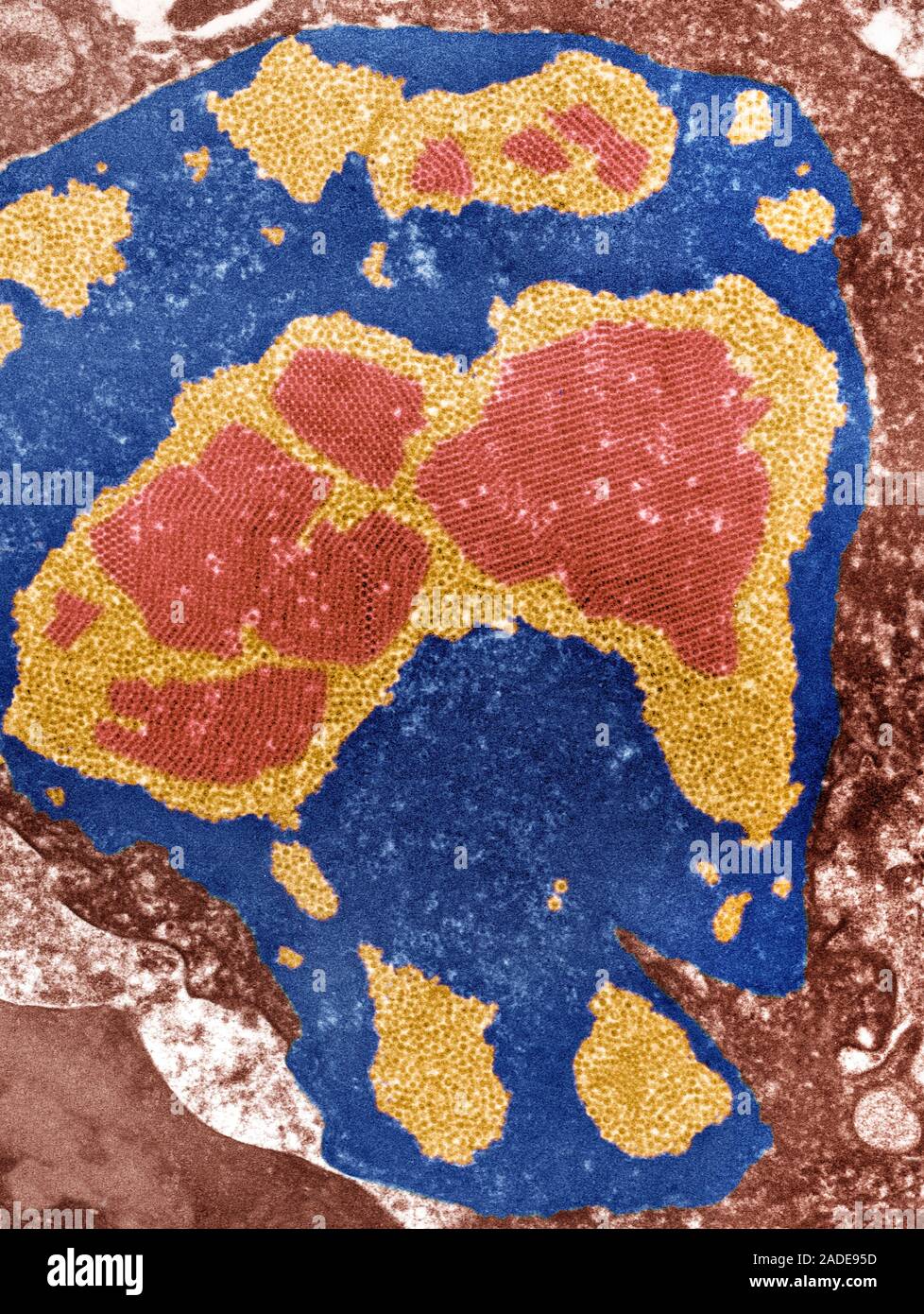 Papillomavirus particles. Coloured transmission electron micrograph ...
