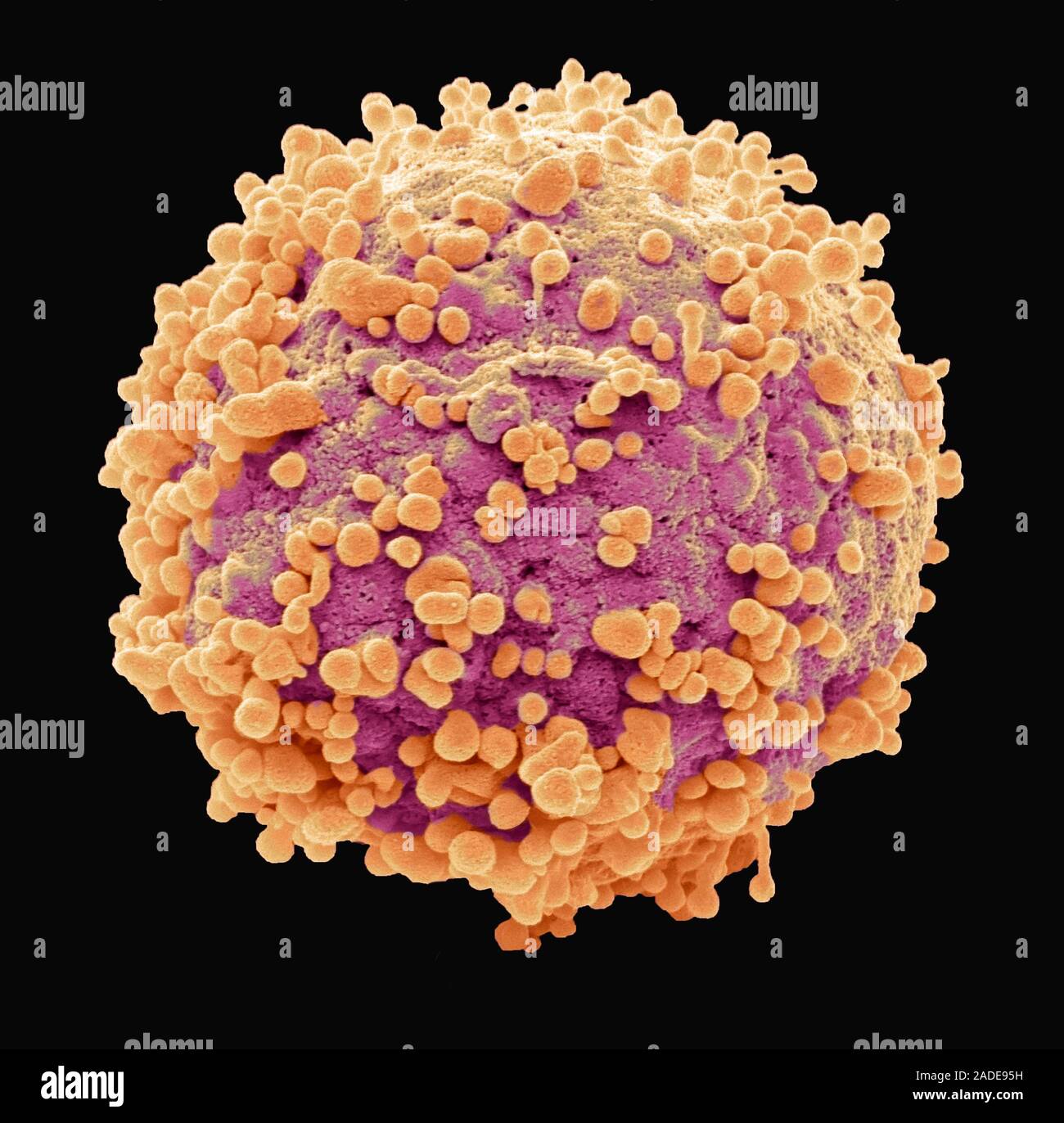 Apoptosis. Coloured scanning electron micrograph (SEM) of a brain ...