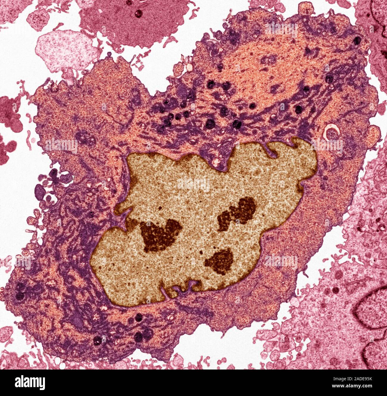 Lung cancer cells. Coloured transmission electron micrograph (TEM) of a ...
