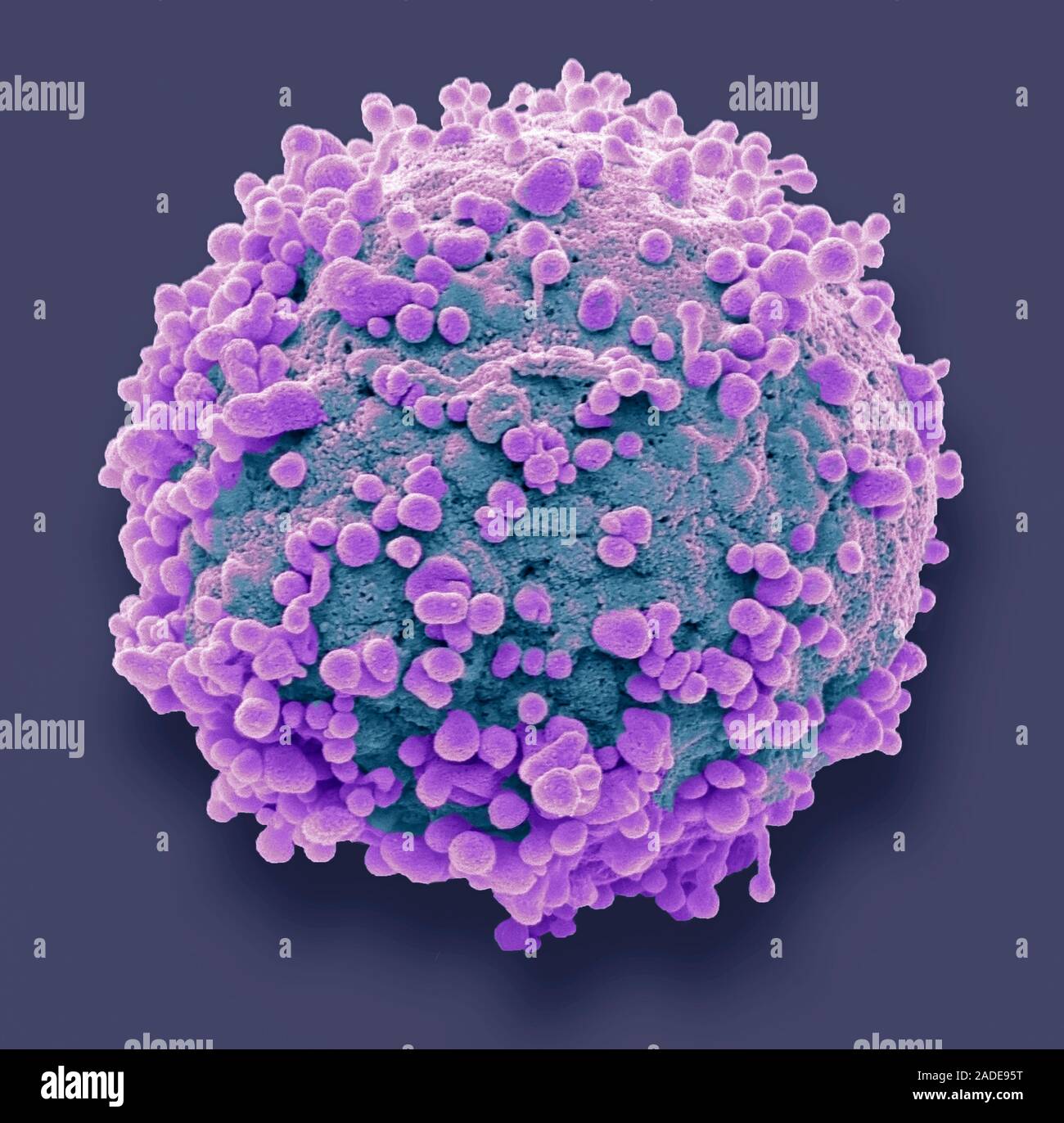 Apoptosis. Coloured scanning electron micrograph (SEM) of a brain ...