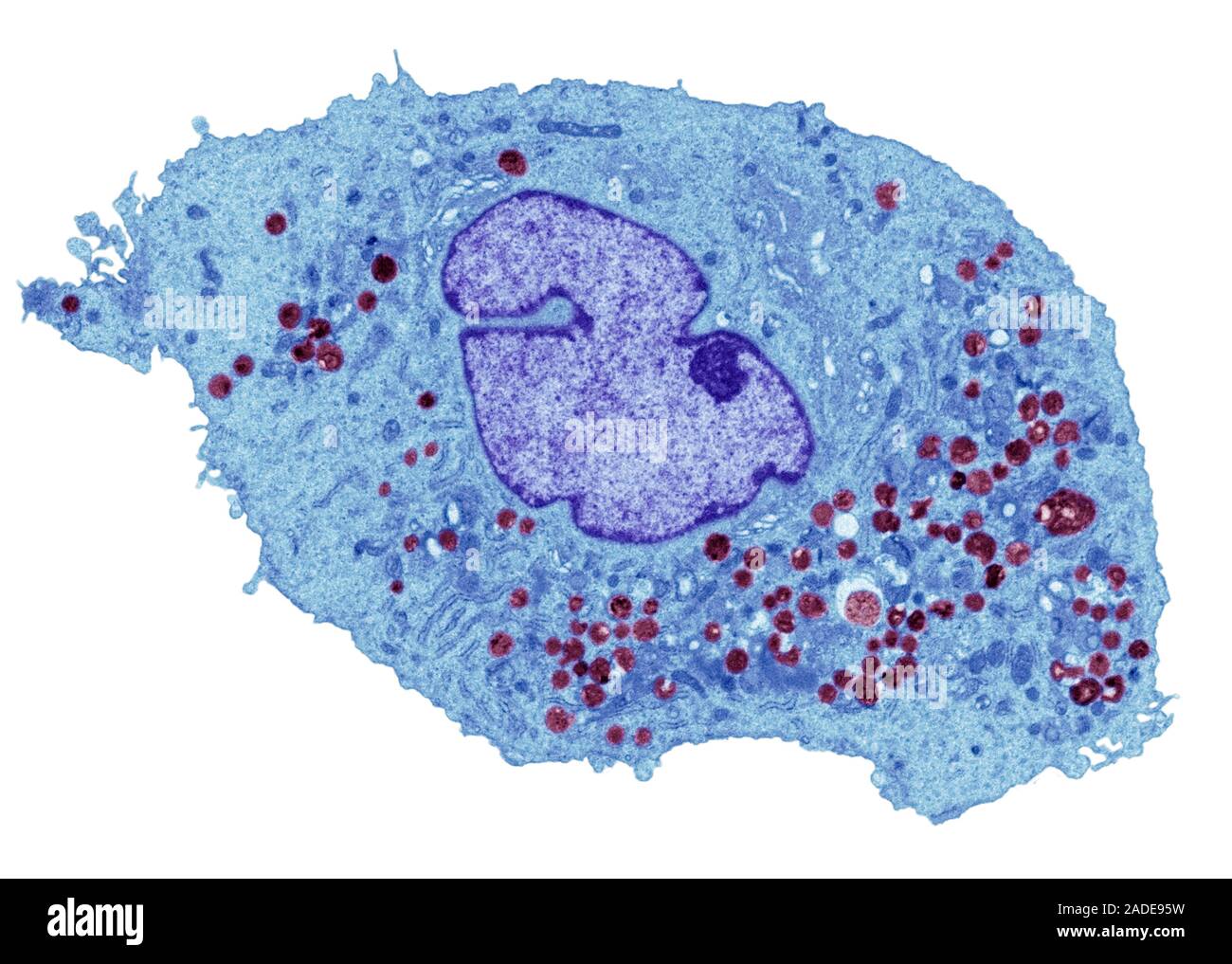Lung cancer cell. Coloured transmission electron micrograph (TEM) of a ...