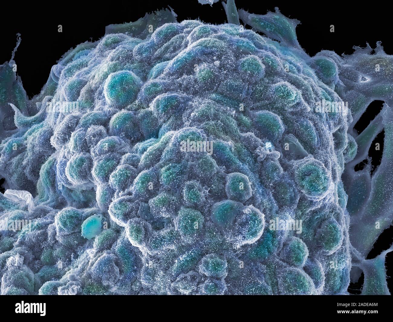 Images not to be used by the tobacco industry. Prostate cancer cells ...