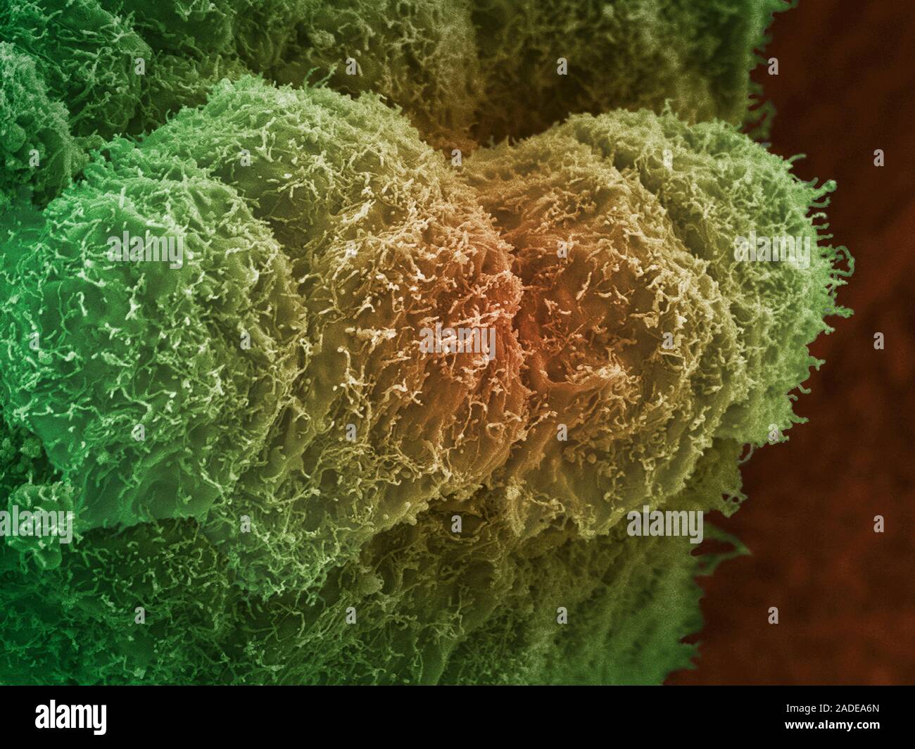 Images not to be used by the tobacco industry. Prostate cancer cells ...