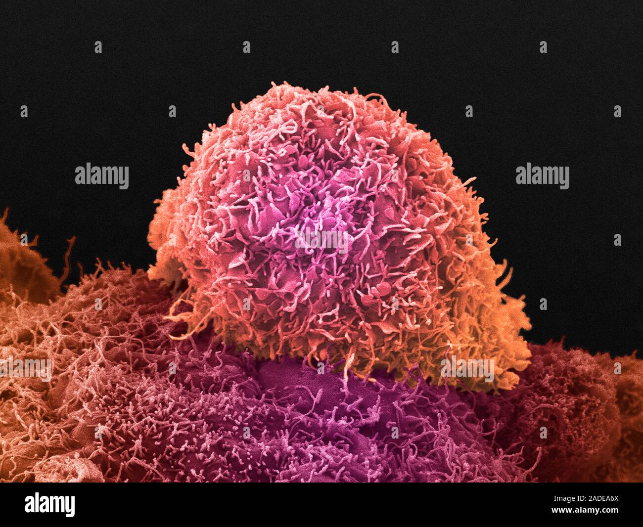 Images not to be used by the tobacco industry. Prostate cancer cells ...