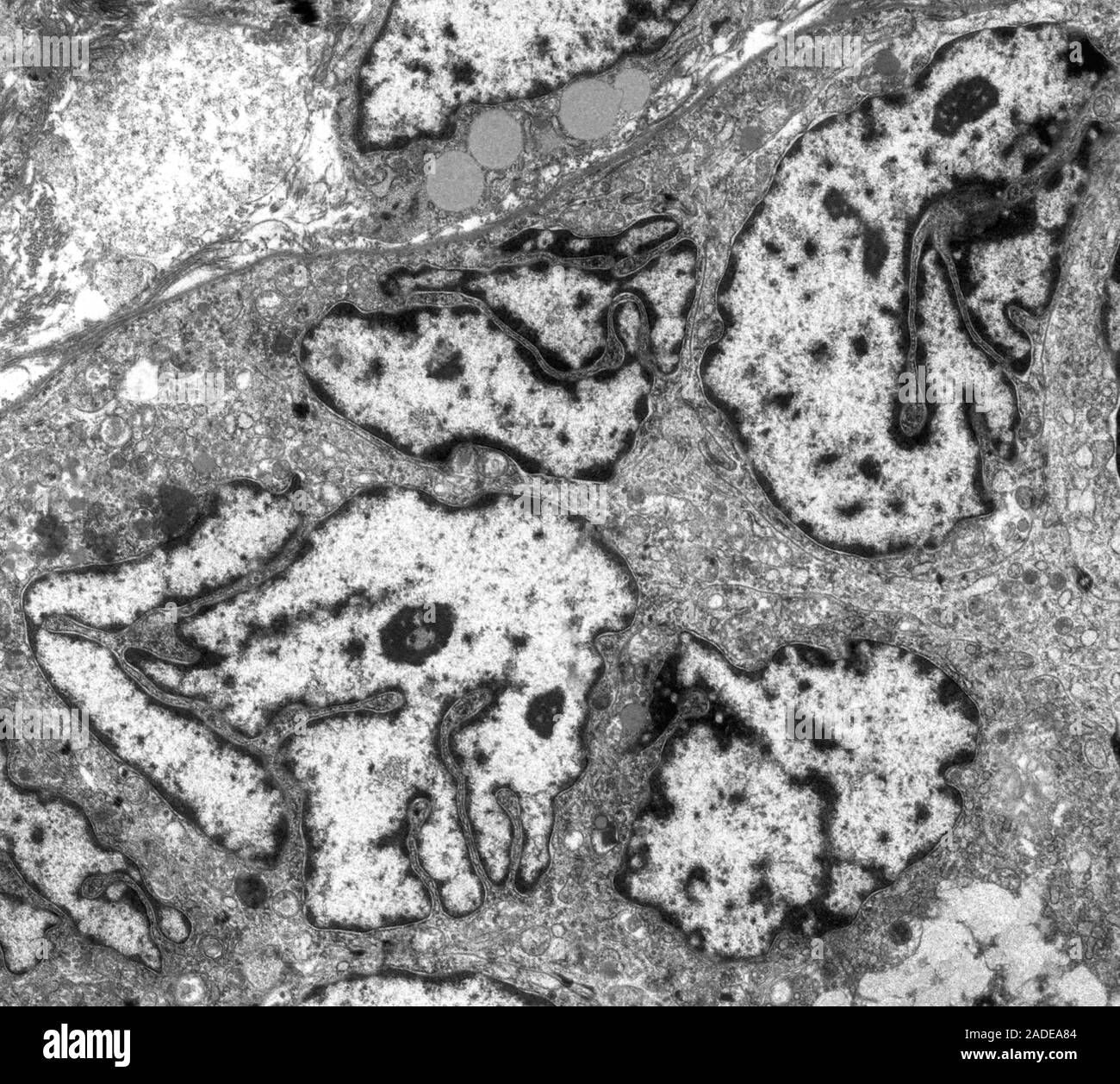 Liver cancer cells. Black and white transmission electron micrograph ...