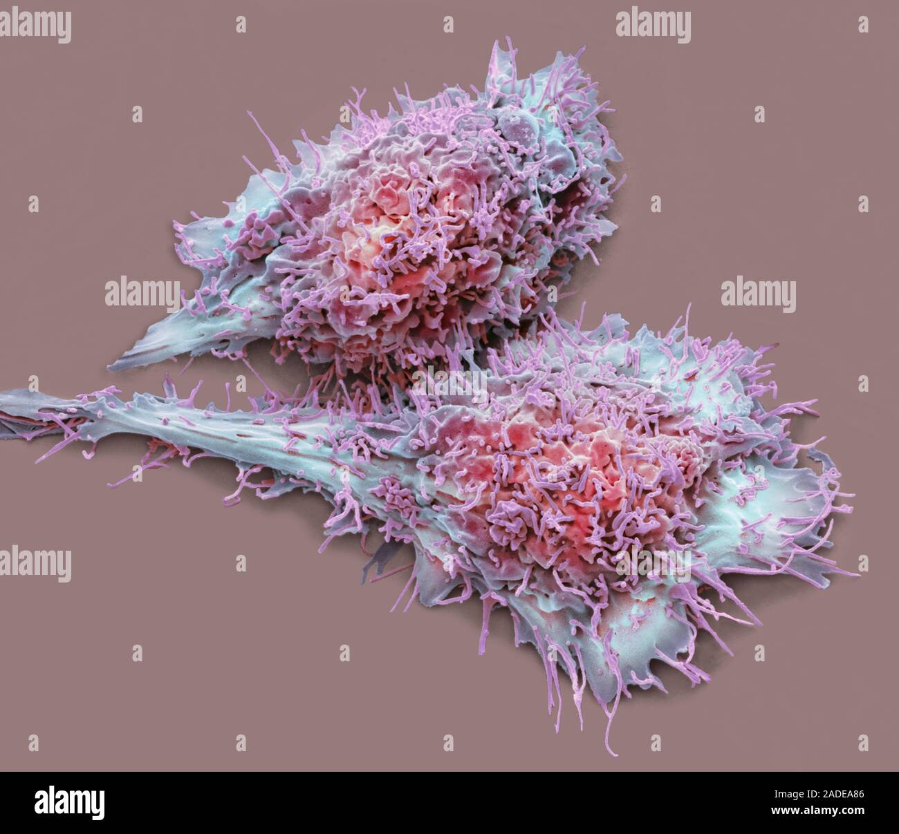 Liver cancer cells. Coloured scanning electron micrograph (SEM) of ...