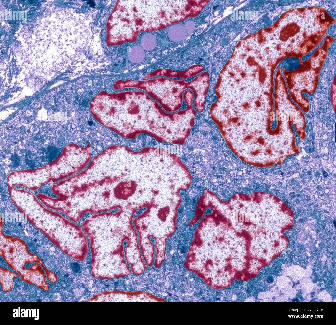 Liver cancer cells. Coloured transmission electron micrograph (TEM) of ...