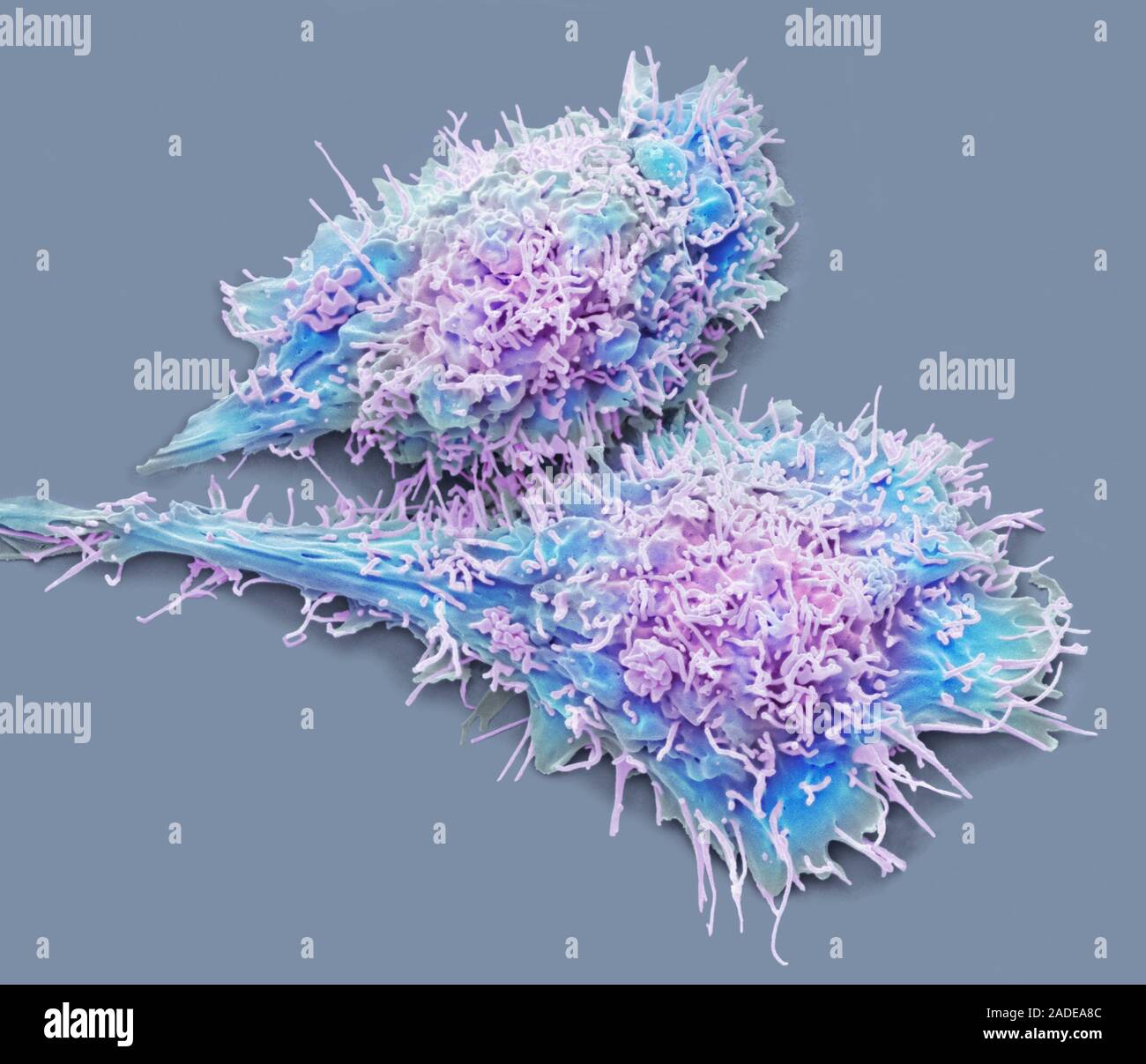 Liver cancer cells. Coloured scanning electron micrograph (SEM) of ...