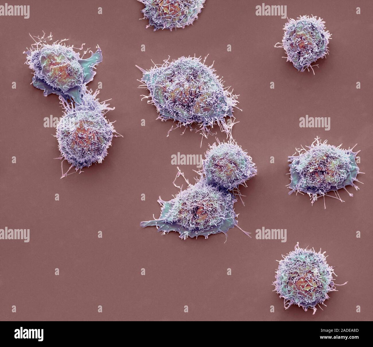 Lymphoma cancer cells. Coloured scanning electron micrograph (SEM) of ...