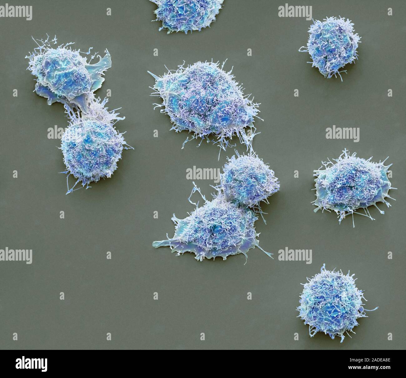 Lymphoma cancer cells. Coloured scanning electron micrograph (SEM) of ...